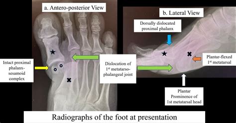 To Reduce Or Not To Reduce Emergency Medicine Journal