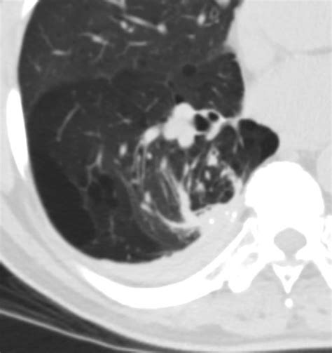 Finding Lungs Rounded Atelectasis Comet Tail Sign The Common Vein