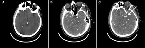 Machine Learning Automated Detection Of Large Vessel Occlusion From Mobile Stroke Unit Computed