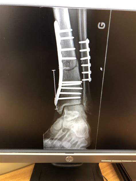 Compound Fracture Of Tibia And Fibula Recovery