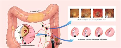 Endoscopy For Colon Cancer