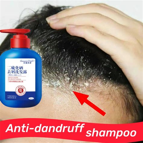Selenium Disulfide Shampoo Kelemumur Dan Gatal Kepala Psoriasis Scalp Anti Dandruff Shampoo