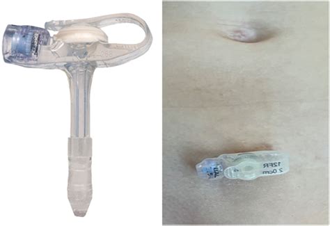 Suprapubic Vesicostomy Buttons Indications Complications And Bladder