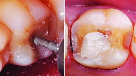 Tooth 36 Initial View Showing Defective Composite Resin Restoration Download Scientific Diagram