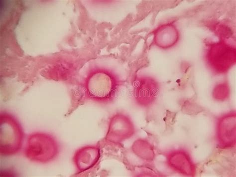 Crytpococcus Neoformans Stained With Mucicarmine In Lung Biopsy Stock