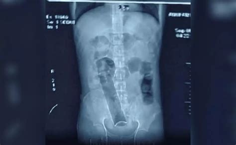 Ins Lito Estuvo Tres Semanas Con Un Desodorante En El Ano