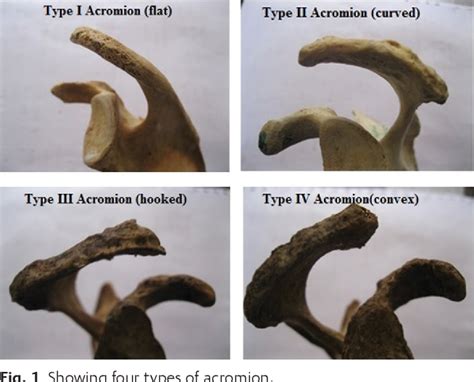 Types Of Acromion Shapes
