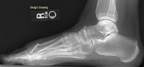 Treating Hallux Limitus In Athletes Podiatry Today