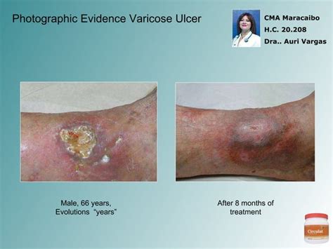 Varicose Ulcer Evidence Part I Circulat Ppt