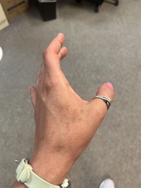 Rash R Dermatologyquestions