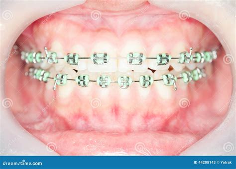 Orthodontic Braces With O Ring Stock Image Image Of Dentistry Braces