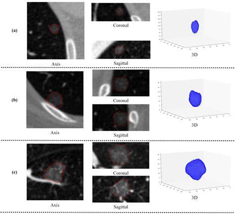 sample cases illustrating segmentation results of ggo nodules a