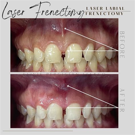 Laser Labial Frenectomy Before And Lee And Co Dental Clinic