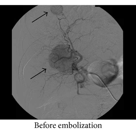 Imaging Before And After Embolization Before Embolization In A A Download Scientific