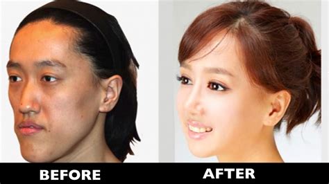 Kpop Plastic Surgery Before And After