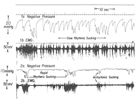 Polygraph Tracings Of Negative Pressure Recordings La And 2a And Emg
