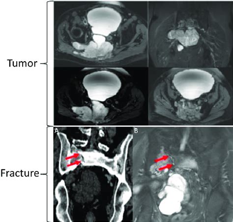 Preoperative Mri Showing Extent Of Tumor Labeled Involvement