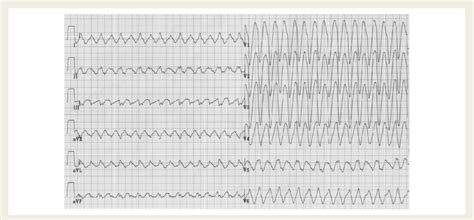 Atrial Flutter With One To One Conduction In A Patient On Oral