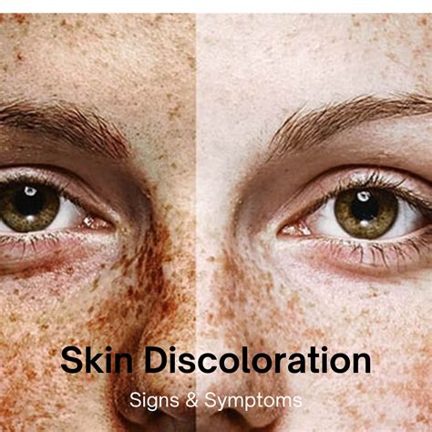 Understanding Skin Discoloration Causes Treatment And Prevention