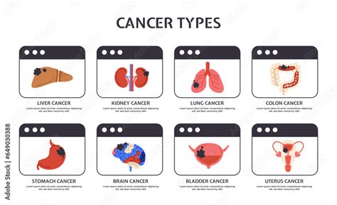 Types Of Cancer Concept Medical Infographics And Educational Materials