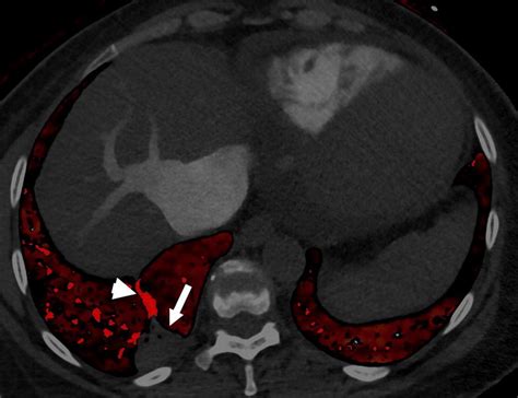 Pulmonary Infarct Axial Pbv Map Shows A Pulmonary Infarct In The