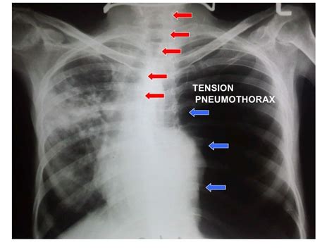 Tension Pneumothorax X Ray Medical Facts Ultrasound