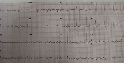 Syncope Medicine Wikipedia