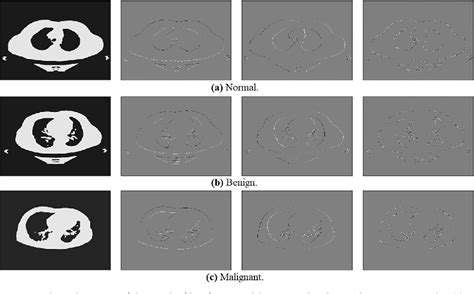 Figure 1 From Automatic Detection And Classification Of Lung Cancer Ct