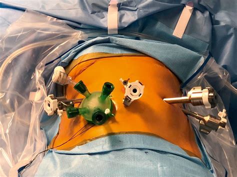 Robotic Pylorus Preserving Pancreaticoduodenectomy And Cholecystectomy Clinical Tree
