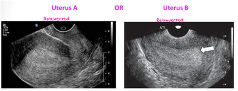 Obgyn Lecture 9 First Trimester Flashcards Quizlet