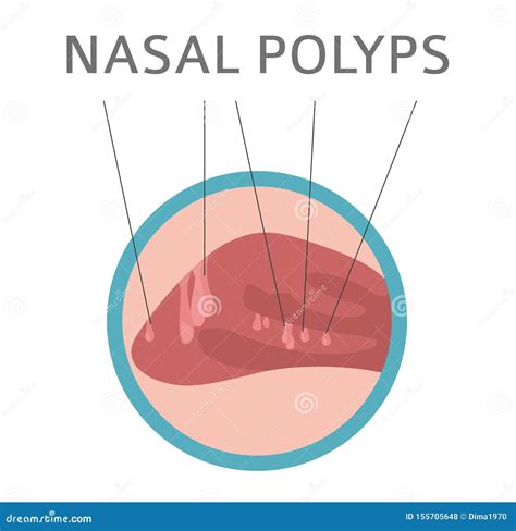 Nasal Diseases Nasal Polyps Causes Diagnosis And Treatment Medical