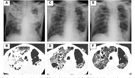 Figure 1 From Acute Respiratory Distress Syndrome Due To Severe