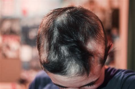 Alopecia Areata Cause Sintomi E Trattamento