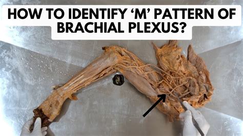 Brachial Plexus Major Branches And Axillary Artery Upper Limb Anatomy Dissection Youtube Brachial Plexus Major Branches And Axillary Artery Upper Limb Anatomy Dissection Youtube
