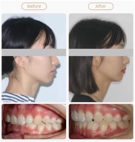 S8 Sgtb Mandibular Advancement Shanghai Smartee Denti Technology Co