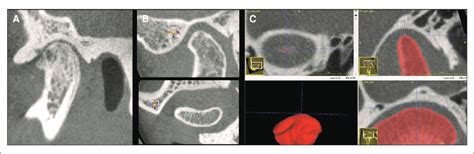 TMJ Imaging Protocol A Small FOV Hr CBCT Scans For TMJ Imaging Download Scientific Diagram