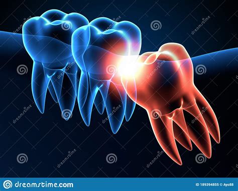3d Render Of Jaw X Ray With Wisdom Mesial Impaction Stock Illustration