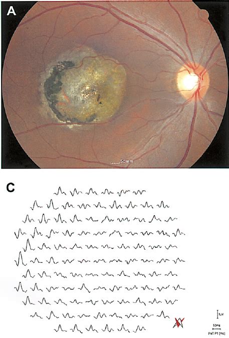Fundus Photographs Of Patient 1 A B Showing Large Chorioretinal