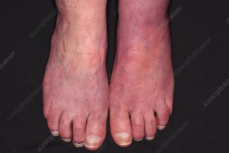 Vascular Issues Feet Peripheral Vascular Disease Sutherland Podiatry