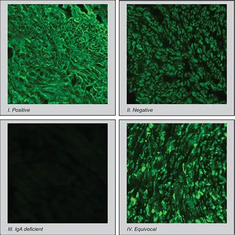 Endomysial Antibody Igm Test Price In Delhi Cost Near Me India