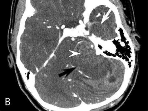 A Bone Algorithm Axial Ct Image Demonstrates The Typical Chondroid Download Scientific