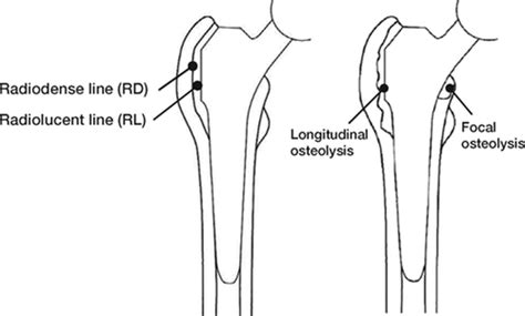 Full Article Radiolucent Lines And Osteolysis Along Tapered Straight