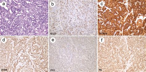 High Grade Neuroendocrine Carcinoma