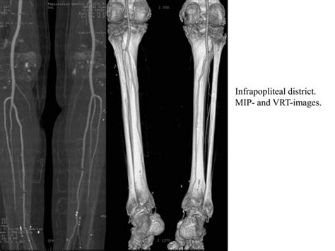 Ct Angiography Lower Limb Pptx