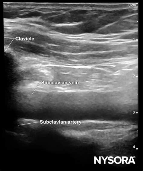 Tips For Subclavian Vein Cannulation NYSORA