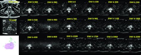 Teaching Point Each Individual B Values In Prostate Dwi Can Provide