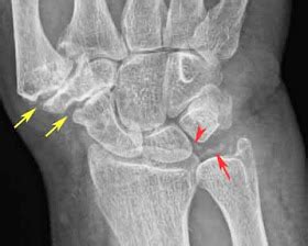 RiT Radiology Calcium Pyrophosphate Dihydrate CPPD Crystal Deposition Disease Of The Wrist