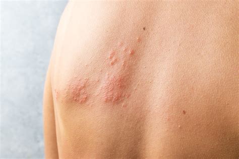Viral Rashes — Brannata Dermatology