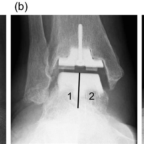 A Measurement Of Talar Component Subsidence Using A Sagittal Plane