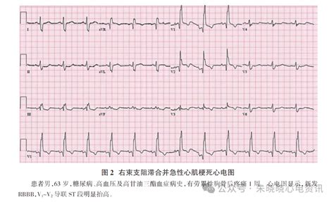 早读 右束支阻滞合并ami 的心电图诊断 好医术文章 好医术 赋能医生守护生命